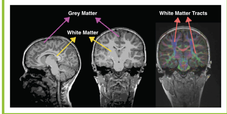 Autism vs schizophrenia: gray matter vs white matter | Pumpkin Person